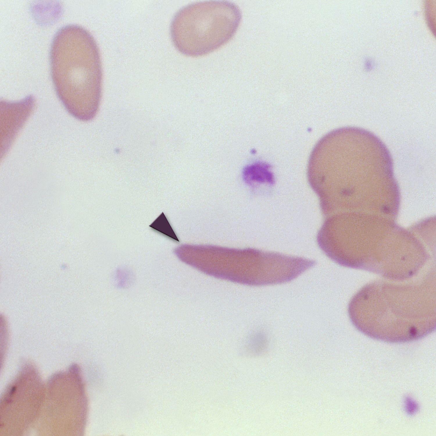 The FDA Approved The First CRISPR-Based Therapy. What’s Next? | Science ...