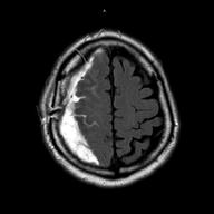 How A Simple Bump Can Cause An Insidious Brain Injury | WNYC