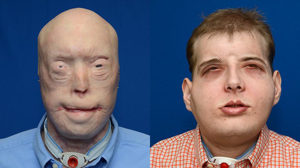 NYU Langone Completes State's First Face Transplant | WNYC | New York ...