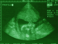 Pro Choice, Pro-Fetus | The Brian Lehrer Show | WNYC Studios